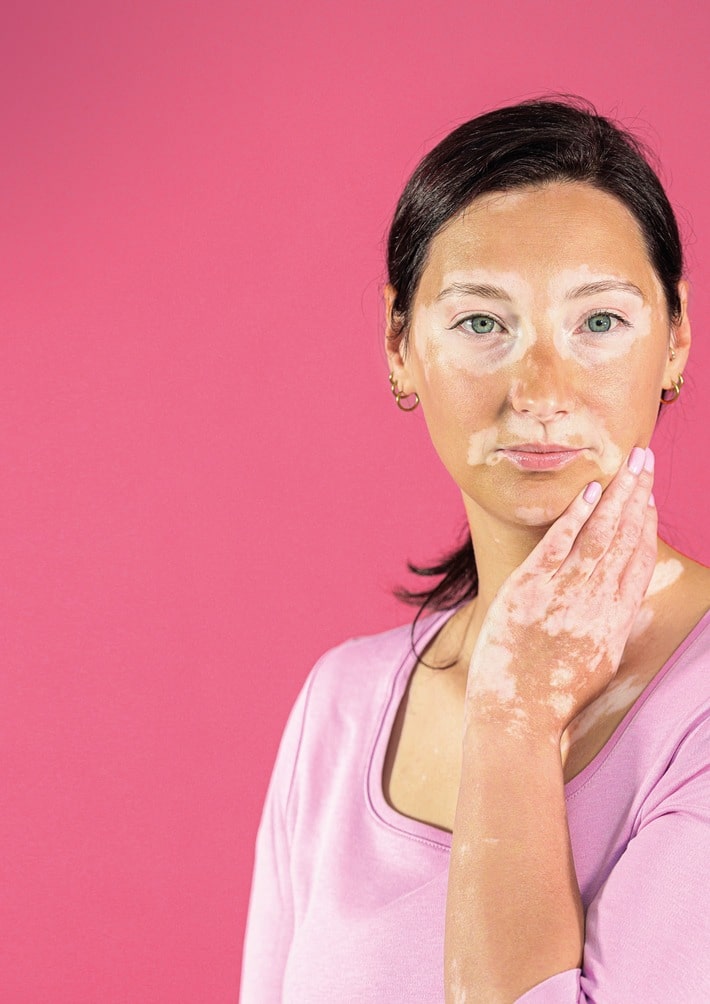 Welt-Vitiligo-Tag: Die Zeit ist reif - Für Betroffene mit Vitiligo lohnt sich ein Besuch beim ...